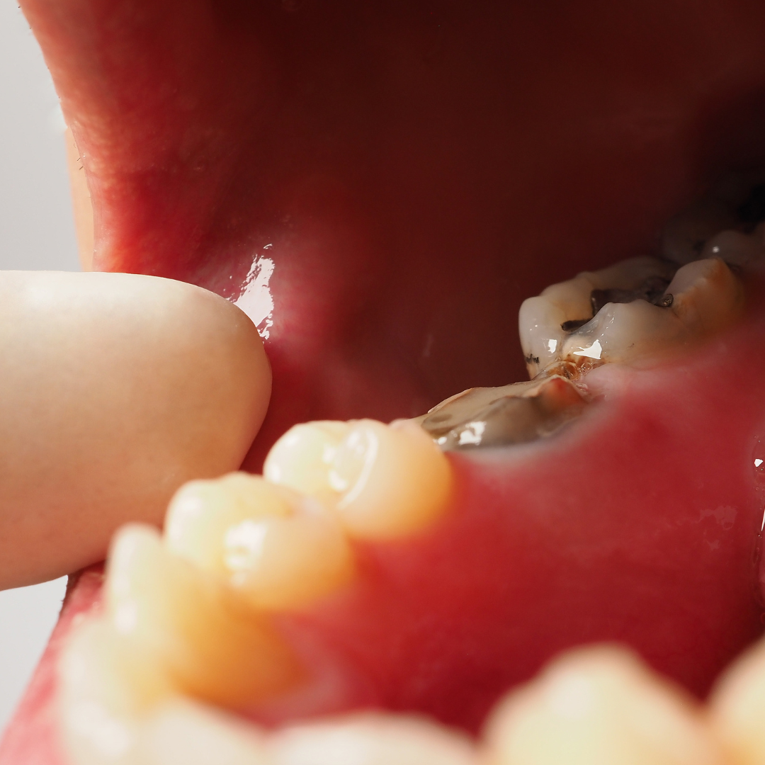 Tooth Decay – Anchorage Project Access