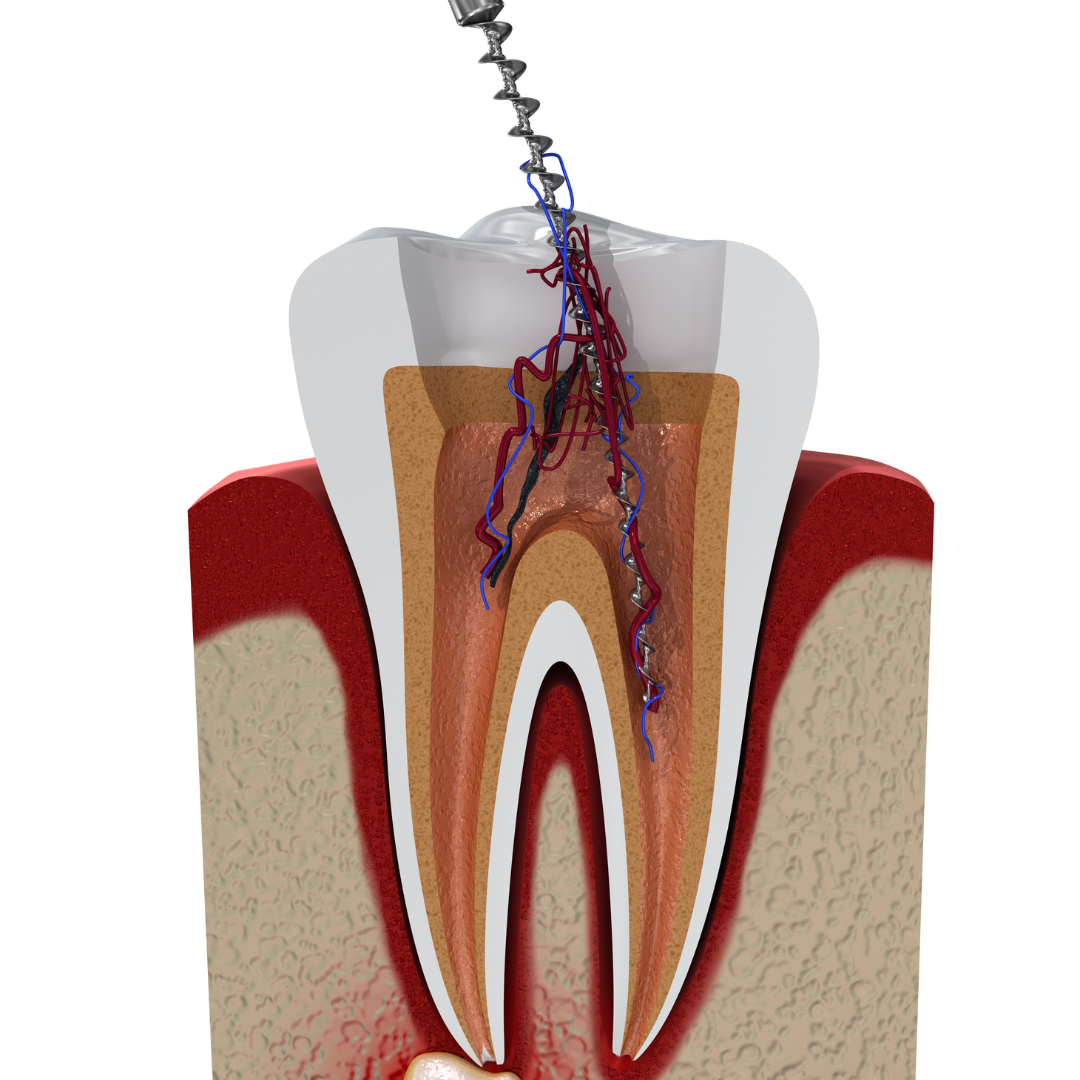 Root Canals – What’s Involved in Root Canal Repair? – Anchorage Project ...