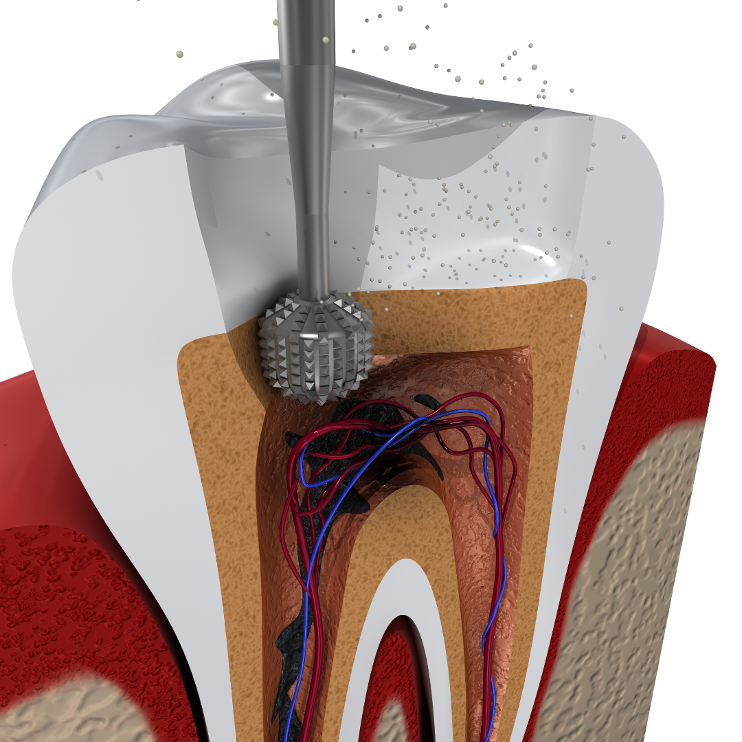 Root Canals – How Long Will a Root Canal Filling Last? – Anchorage ...